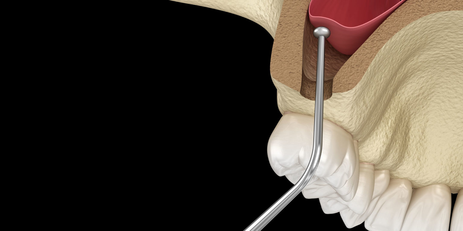 Sinus Lift, Sinus Augmentation - Monroe, CT - Periodontist
